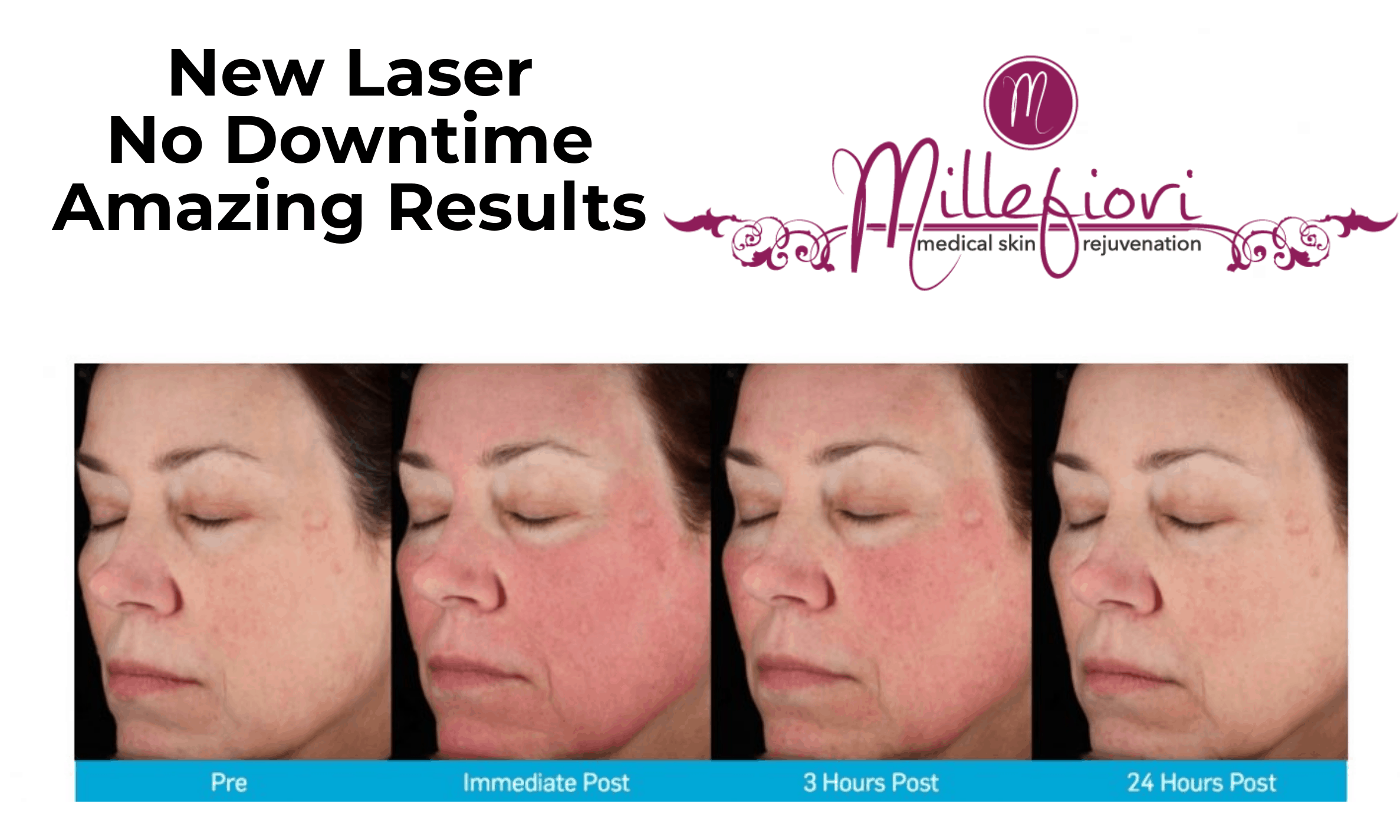 No Downtime Laser Resurfacing! - Millefiori Aesthetics