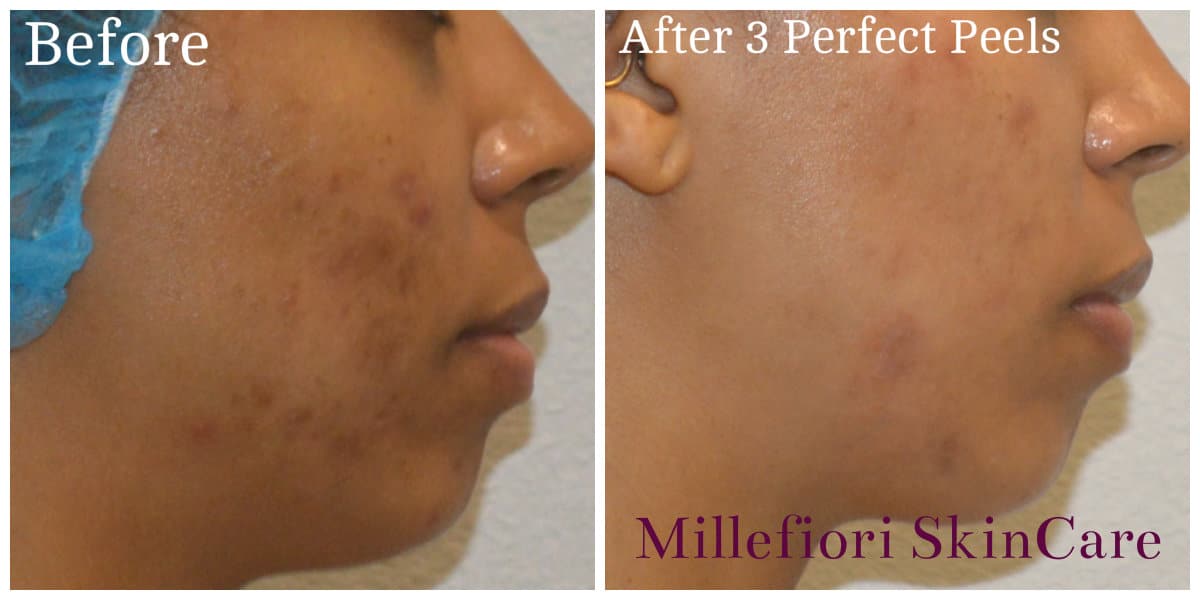 Chemical Peels for Fall and Why a Peel Is the Perfect Reset ...